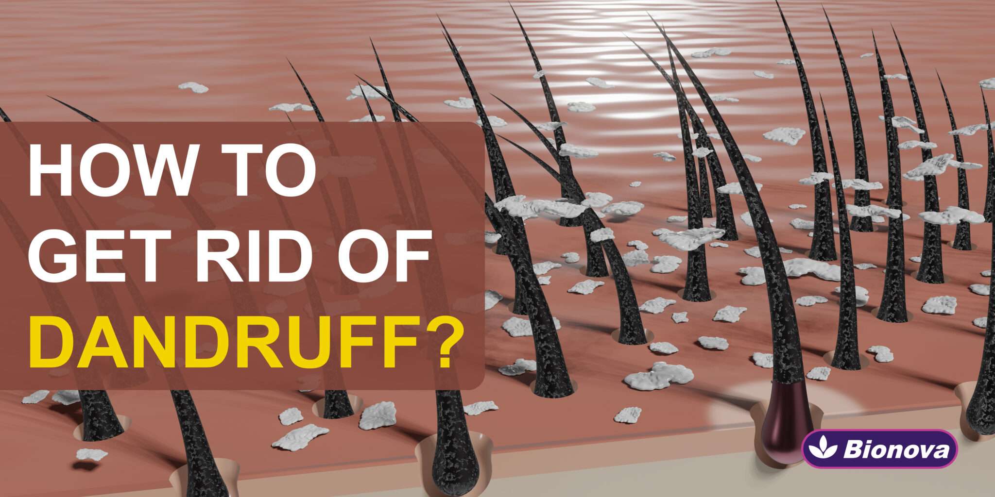 How to get rid of dandruff